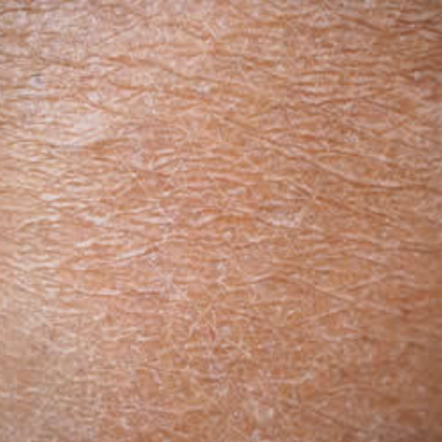 Dry Skin: Symptoms, Causes, Treatment and Prevention - Livara Natural ...